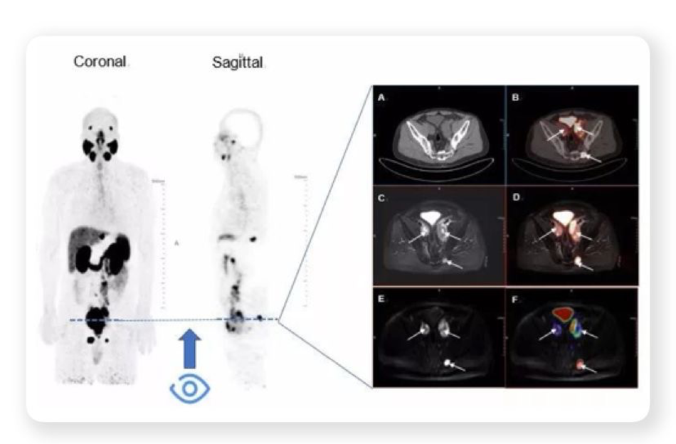 CT VS PET Scan for Prostate Cancer Diagnosis /MR| UIH